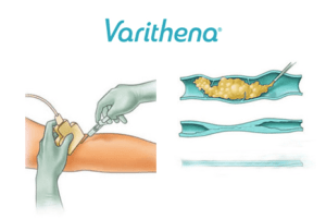 Varithena in Mesa, AZ | Tri City Vein Center